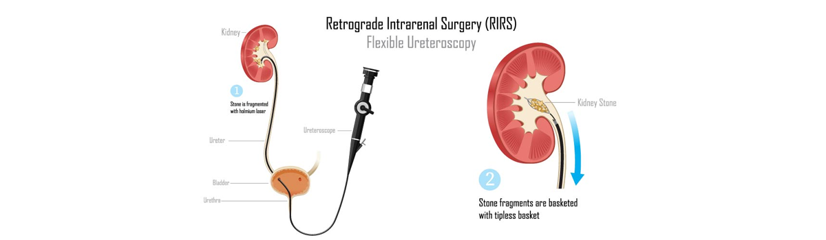 Home | Laser Retrograde Intrarrnal Surgery